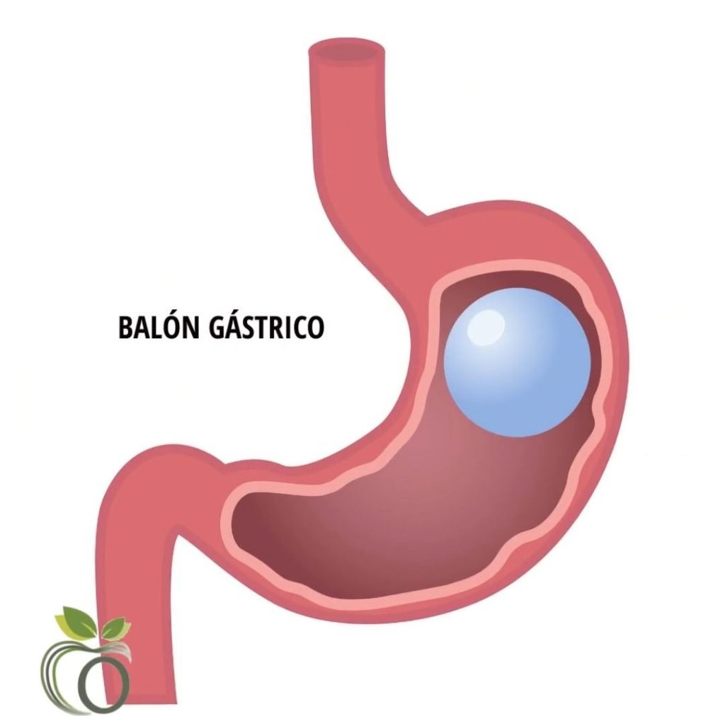Balón Gástrico Ingerible de 6 Meses | Obesis | Andalucía | [Click Aquí]